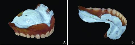 A Scan Of Maxillary Denture B Scan Of Mandibular Denture Download