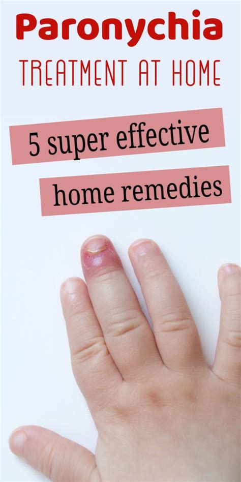 Paronychia Finger Home Treatment Gdvpdj