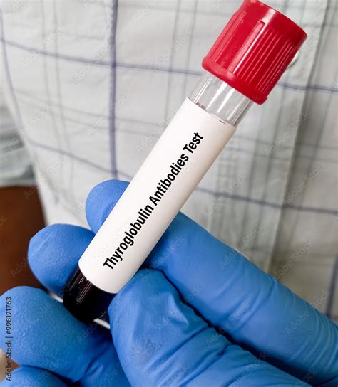 Blood Sample For Thyroid Peroxidase Antibodies Or Anti Tpo Test And