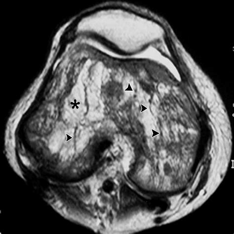 Pagets Disease Vertebral Body Radiology At Sue Harris Blog