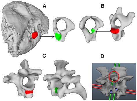 Pivot Joint Atlas Axis