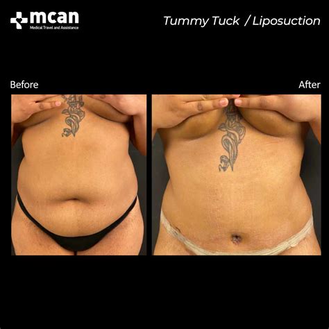 What Is Fupa Remedies For Dreadful Situation Fupa Mcan Health Blog