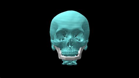 Defect Implant 11621a0bc9c04e85bc9d2239ca6d2a52 3d Model By Healthgate [11621a0] Sketchfab