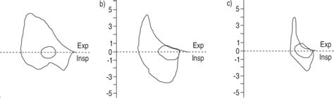 Tidal And Maximal Flowvolume Curves Of Three Representative Cystic