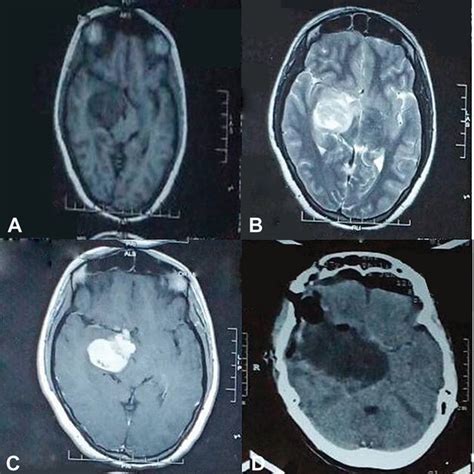 Contrast Enhanced Magnetic Resonance Imaging Mri Imaging Showing Download Scientific Diagram