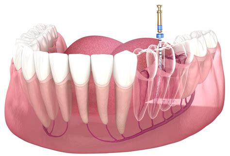 Root Canals Dental Care Of Mesa Mesa Az 85206