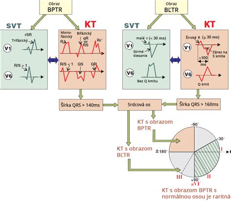 Brugada Algoritmus Kt Vs Aberantná Svt Ekg Kniha Techmed