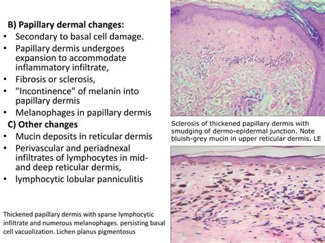 Interface Dermatitis Tutorial Pptx