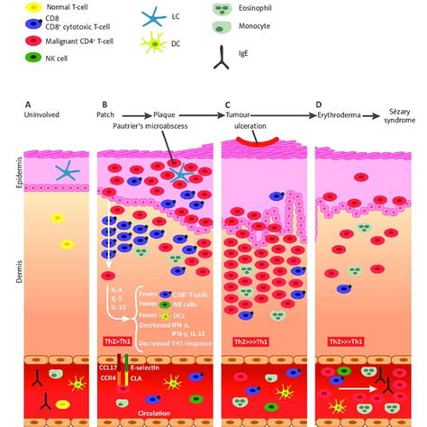 the skin microenvironment in mf progression a normal skin b patch and