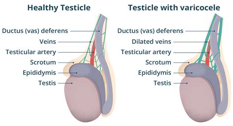Andrologia Bologna Varicocele Symptoms Disorders At The Testicular