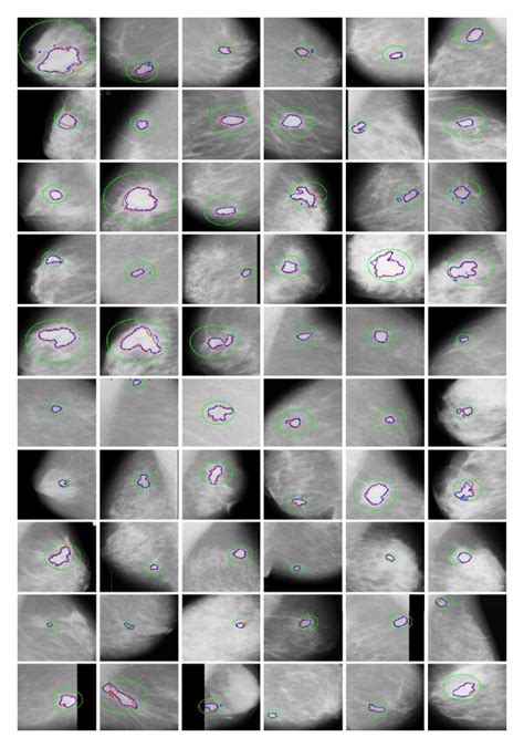 Examples Of Successful Tumor Tissue Segmentation From Mini Mias