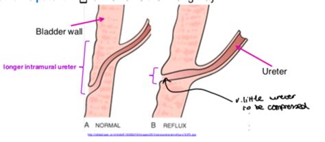 Obstructive Uropathy Part 2 Flashcards Quizlet