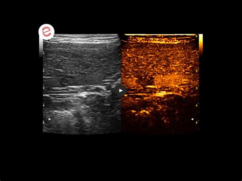 Adrenal Adenoma Esaote