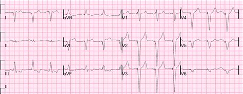 Paced Rhythm Is There Ischemic St Elevation Dr Smiths Ecg Blog