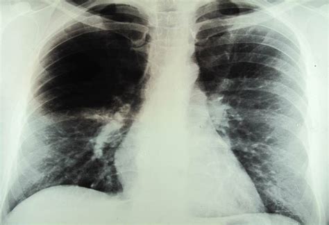 A Chest X Ray Revealing Diffuse Infiltrates That Were Predominantly Download Scientific Diagram