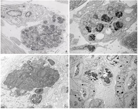 Variety Of Deposits Under Electron Microscopy A “zebra Bodies” In A Download Scientific