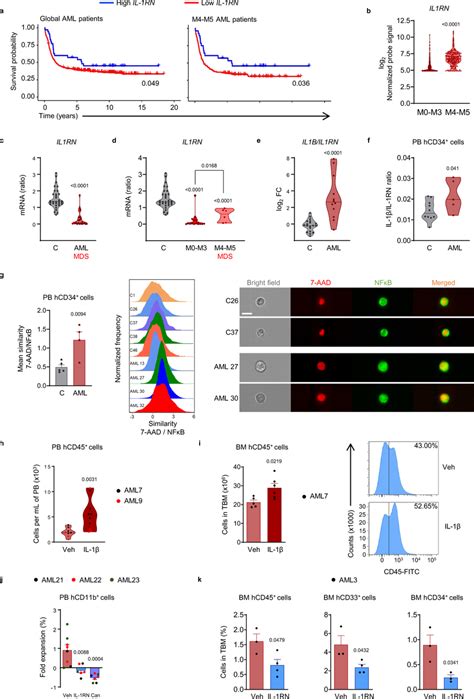 Low IL 1RN Predicts AML Progression In Patients A Global AML Patient Download Scientific