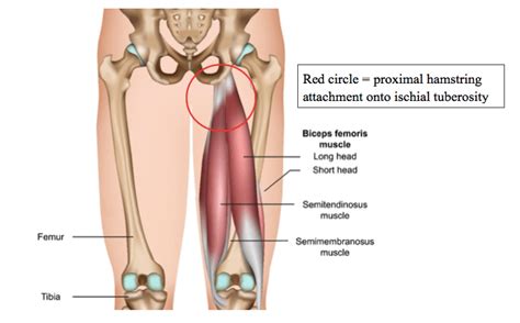 Proximal Hamstring Tendinopathy Ultrasound Guided Injections