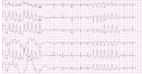 Ventricular Tachycardia — The Pulse — Staten Island University Hospital