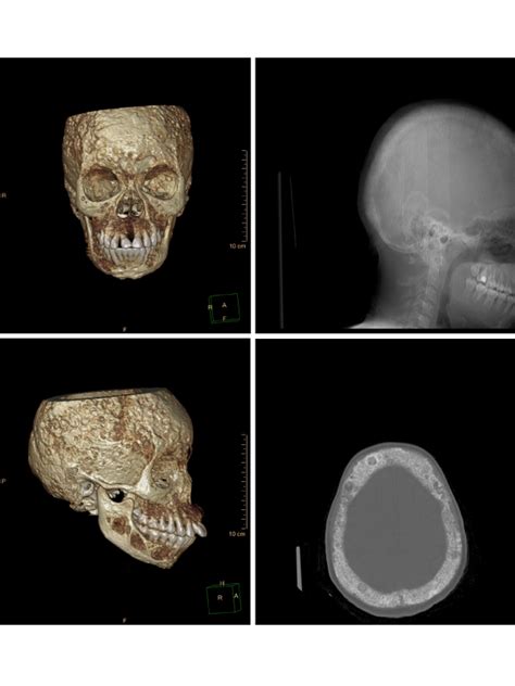 Severe Secondary Hyperparathyroidism International Journal Of Clinical Medical Images
