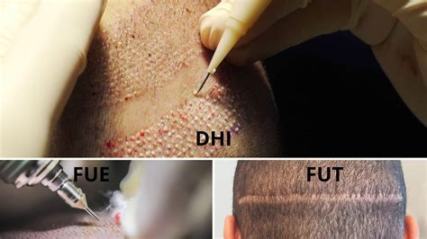 Trasplante De Cabello En Panamá Diferencias Entre Dhi Fue Y Fut Dhi Panamá