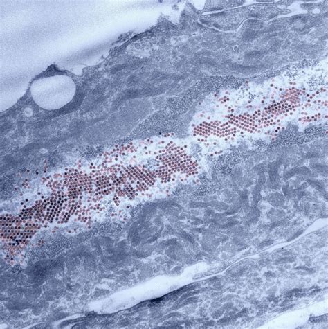 Advanced Hpv Rna Seq Test Developed By The Institut Pasteur Exclusive License Signed With Abl