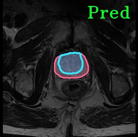 210208005 Transfuse Fusing Transformers And Cnns For Medical Image Segmentation