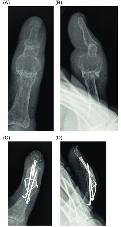 A Chondrosarcoma Of The Left Hand At The Second Metacarpal And Download Scientific Diagram