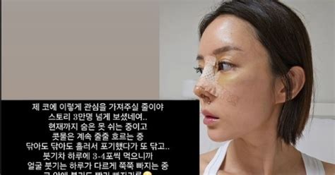 ‘돌싱글즈3 이소라 코 성형 후기 “가슴보다 더 아파 숨 못 쉬는 중”