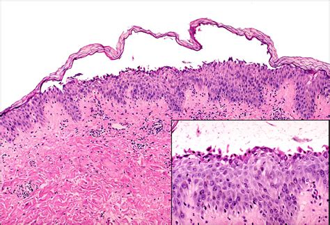 Mimickers Of Classic Acantholytic Diseases Ho 2017 The Journal Of Dermatology Wiley