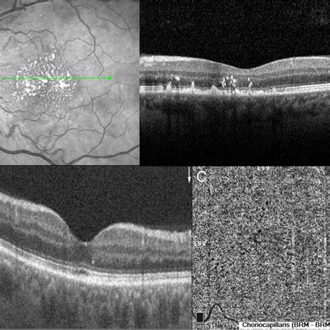exams at baseline a ss oct b scan demonstrates extensive exudative