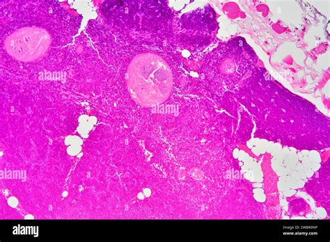 Human Thymus Section With Hassall Corpuscles X75 At 10 Cm Wide Stock