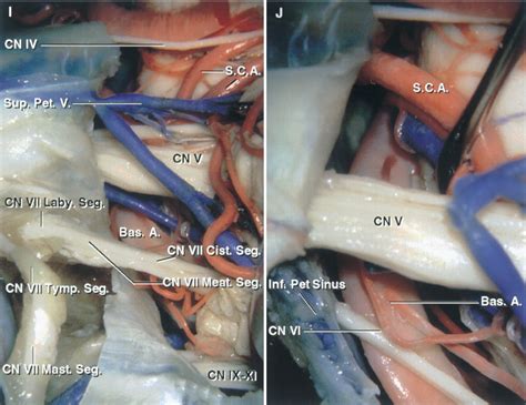 Comparison Of The Retrosigmoid Approach And The Minimal Mastoidectomy Retrolabyrinthine