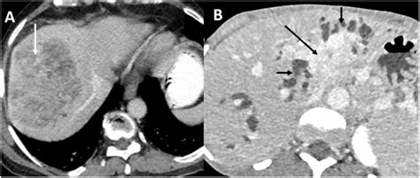 Imaging Appearance Of Small And Large Duct Intrahepatic Download