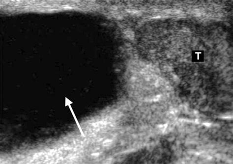 Hydrocele Of The Cord