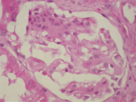 A Glomerulus Showing A Segmental Nodular Lesion With Mesangial