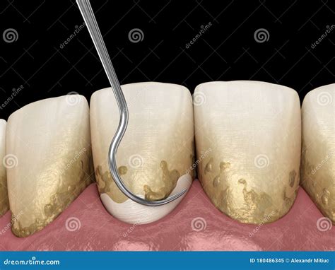 Oral Hygiene Scaling And Root Planing Conventional Periodontal Therapy Medically Accurate 3d