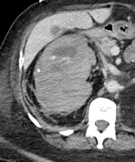 002k Post Biopsy Pseudoaneurysm Hemorrhage Subcapsular Hematoma Post