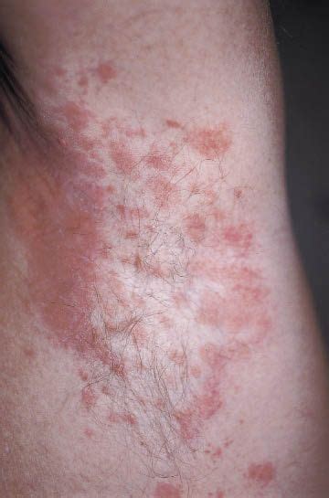 Can You Identify This Axillary Rash