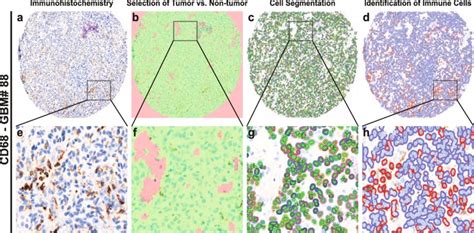 Immune Landscapes Associated With Different Glioblastoma Molecular Subtypes Abstract Europe PMC