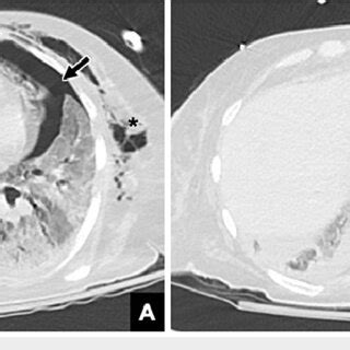 Subsequent Axial CT Of A 76 Year Old Female With Acute Hypoxic Download Scientific Diagram