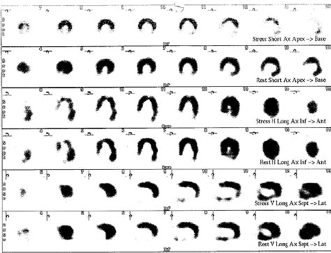 Myocardial Perfusion Scintigraphy After Stem Cell Therapy Download