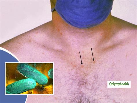 Salmonella Rose Spots At Francis Holston Blog