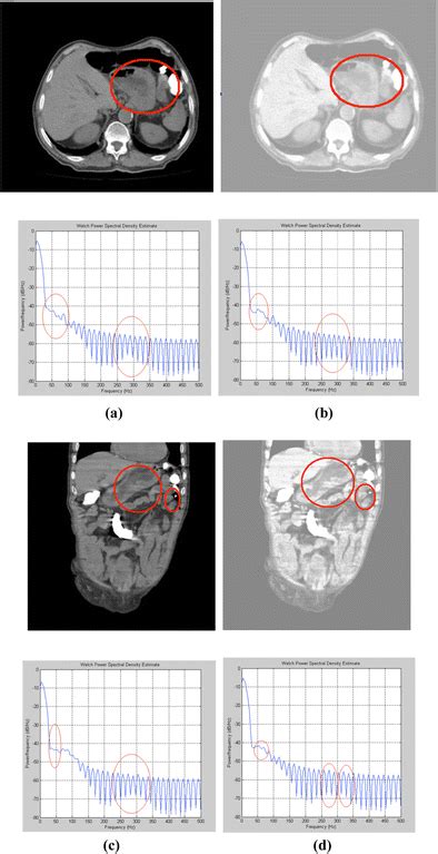 After Median Filtering Obtained Results A Original Ct Image From The