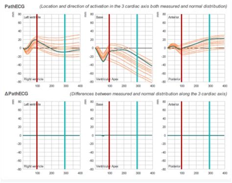 Anyone Can Interpret 12 Lead Ecg Ecg Excellence