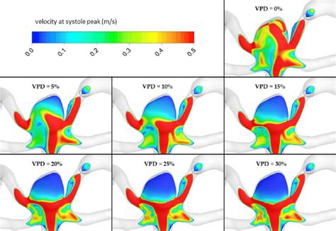 Velocity Distribution At Aneurysm Cross Section For Selected Vpd Cases