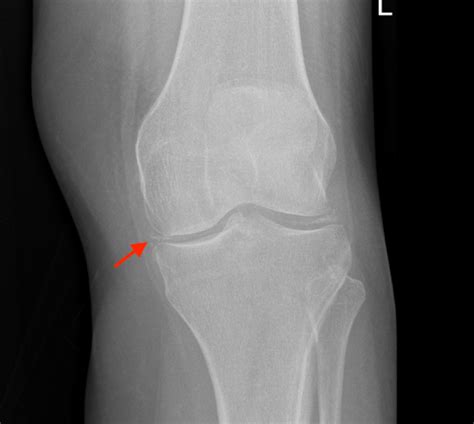 The Msk Playbook Chondrocalcinosis Pathway Bjsm Blog Social Medias Leading Sem Voice
