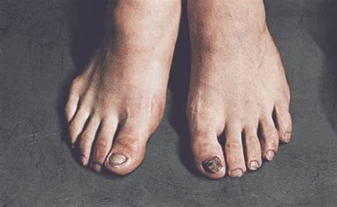 새카만 발톱 멍 이유 있다…255㎜ 작은발 손흥민의 비밀 중앙일보