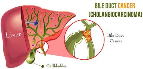 Ayurvedic Treatment Of Cholangiocarcinoma Bile Duct Cancer Herbal