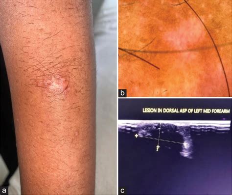 An Asymptomatic Nodular Lesion Over The Forearm A Diagnostic Dilemma Indian Journal Of